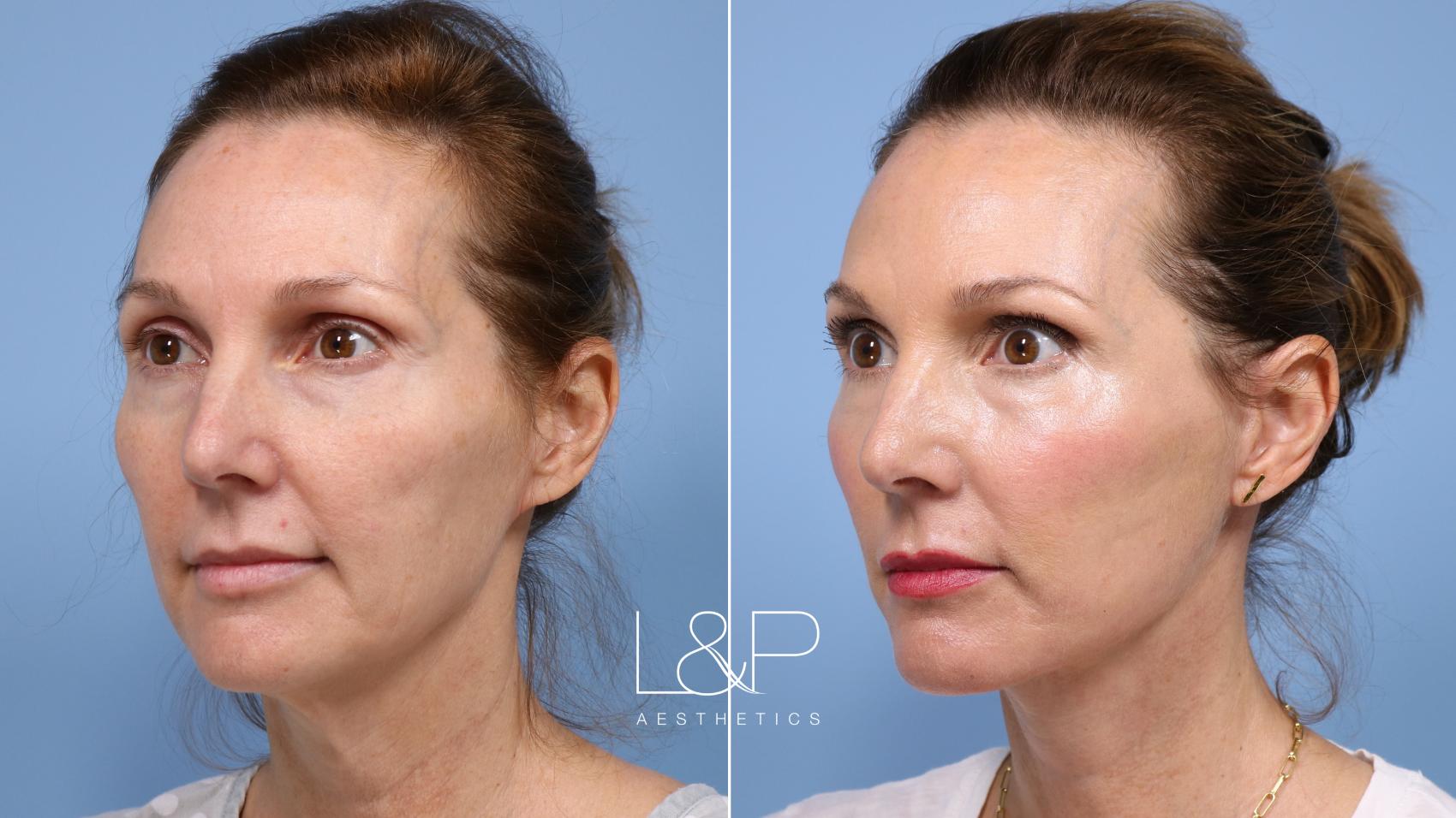 Facelift San Francisco, Palo Alto, & San Jose | L&P Aesthetics