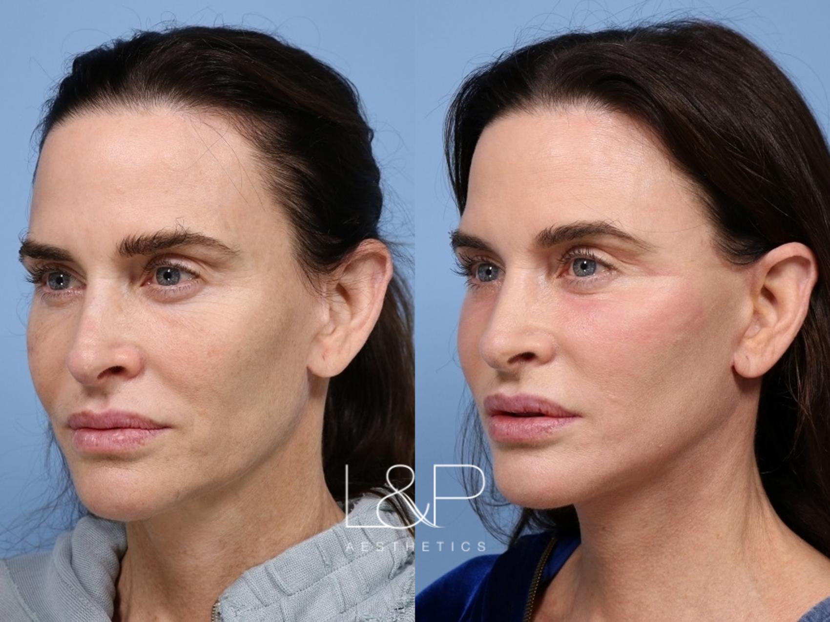 Laser Resurfacing (TRL) Before and After Photo Gallery | Palo Alto ...