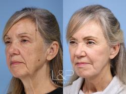 Chin Augmentation Before and After Photo Gallery | Palo Alto & San Jose ...
