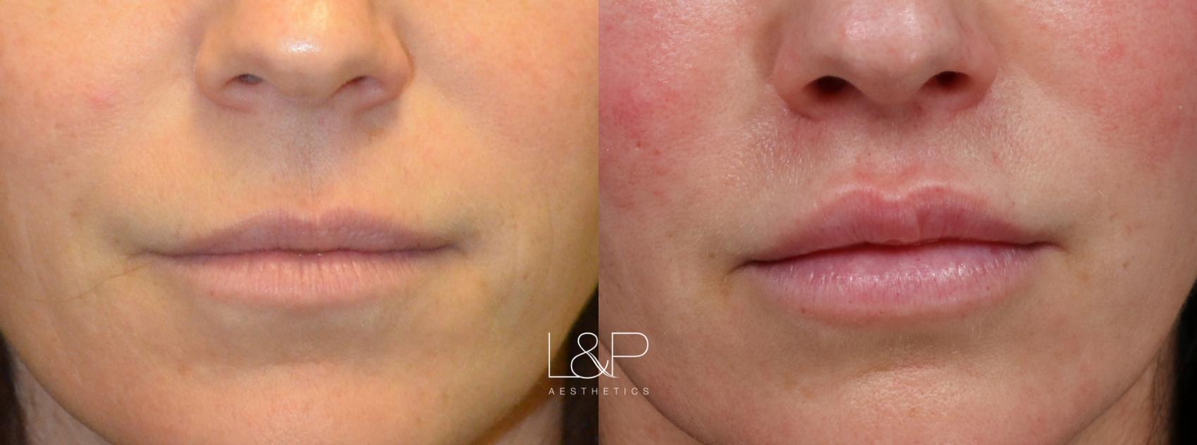 Lip Lift | San Francisco Bay Area, Palo Alto, & San Jose | L&P Aesthetics