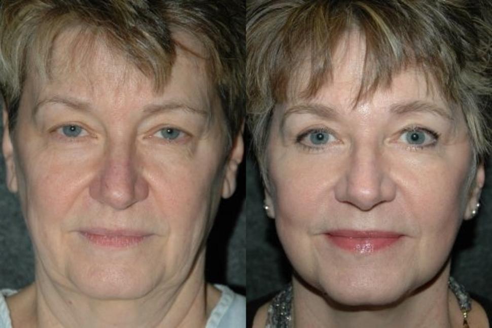 Facelift San Francisco, Palo Alto, & San Jose | L&P Aesthetics