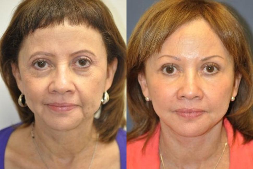 Facelift for Palo Alto & San Jose | L&P Aesthetics