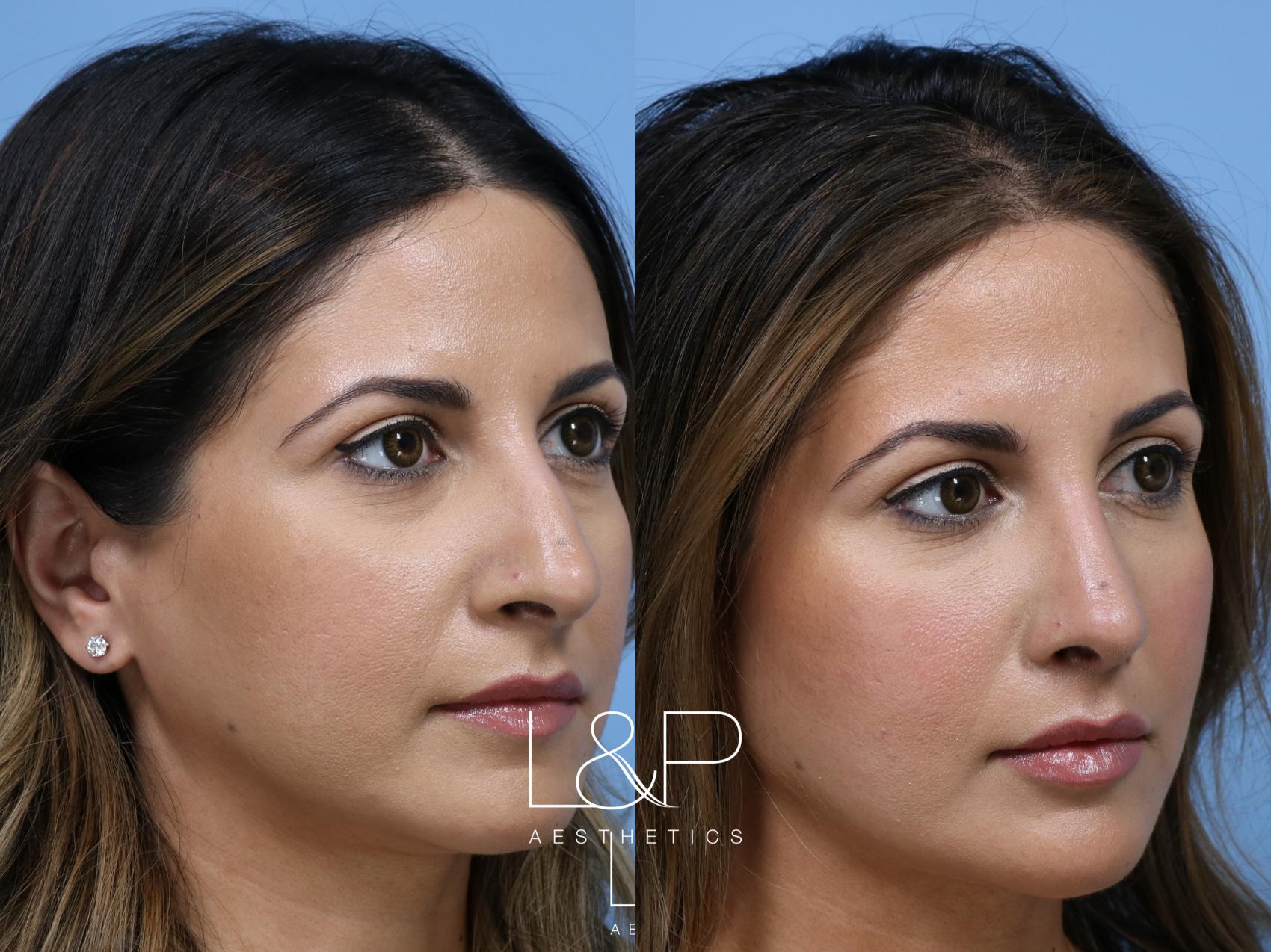 Rhinoplasty Before and After Photo Gallery | Palo Alto & San Jose ...
